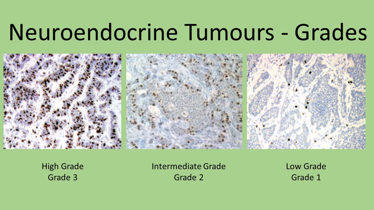 Symptoms Diagnosis And Treatment Of Neuroendocrine Carcinomas Dr Symptoms Diagnosis And Treatment Of Neuroendocrine Carcinomas Dr